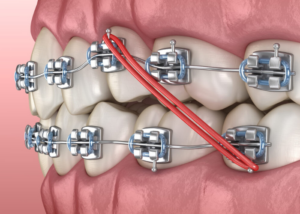 Why Are Elastics Important? - Cooper & Misner Orthodontics