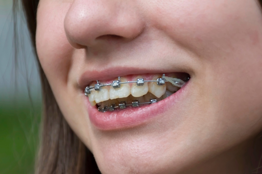 Braces for Overbite in Tulsa, OK - Cooper & Misner Orthodontics